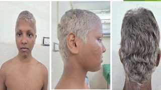 pazopanib depigmentation of hair.pptxugug | PPTX