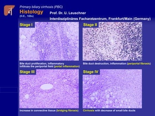 Primary Biliary Cirrhosis Stages Formula