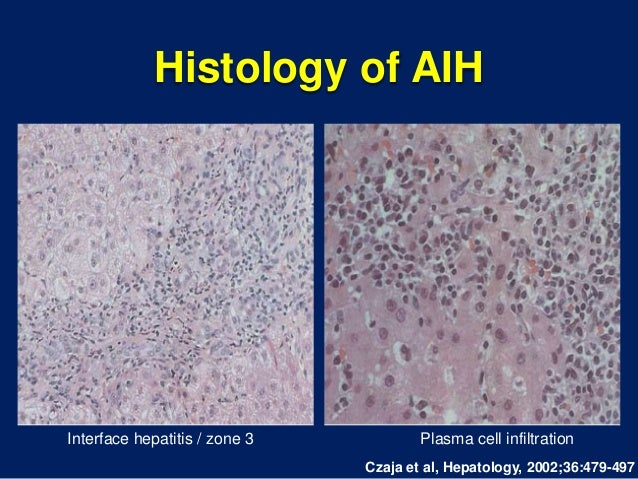 Primary biliary cirrhosis and autoimmune hepatitis 20120902