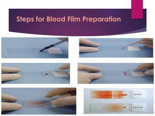Peripheral Blood Film Preparation, Examination And Interpretation | PPTX