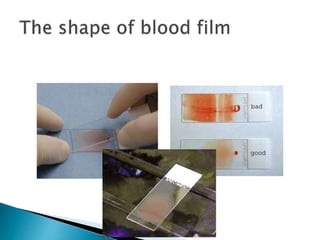 Preparation of peripheral blood flim | PPTX