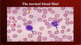 peripheral blood smear spot diagnosis | PPTX