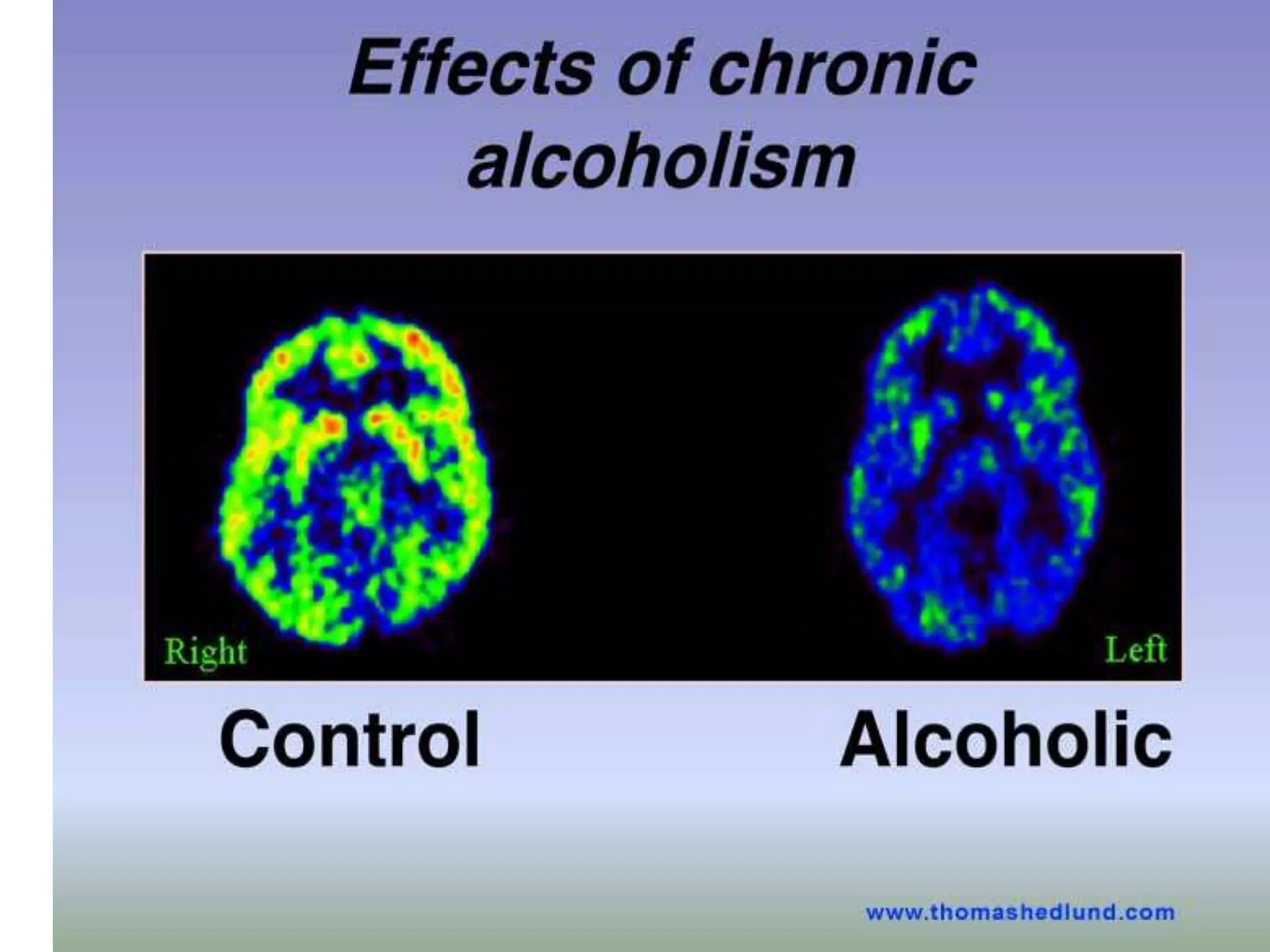 Alcoholism presentation | PPTX