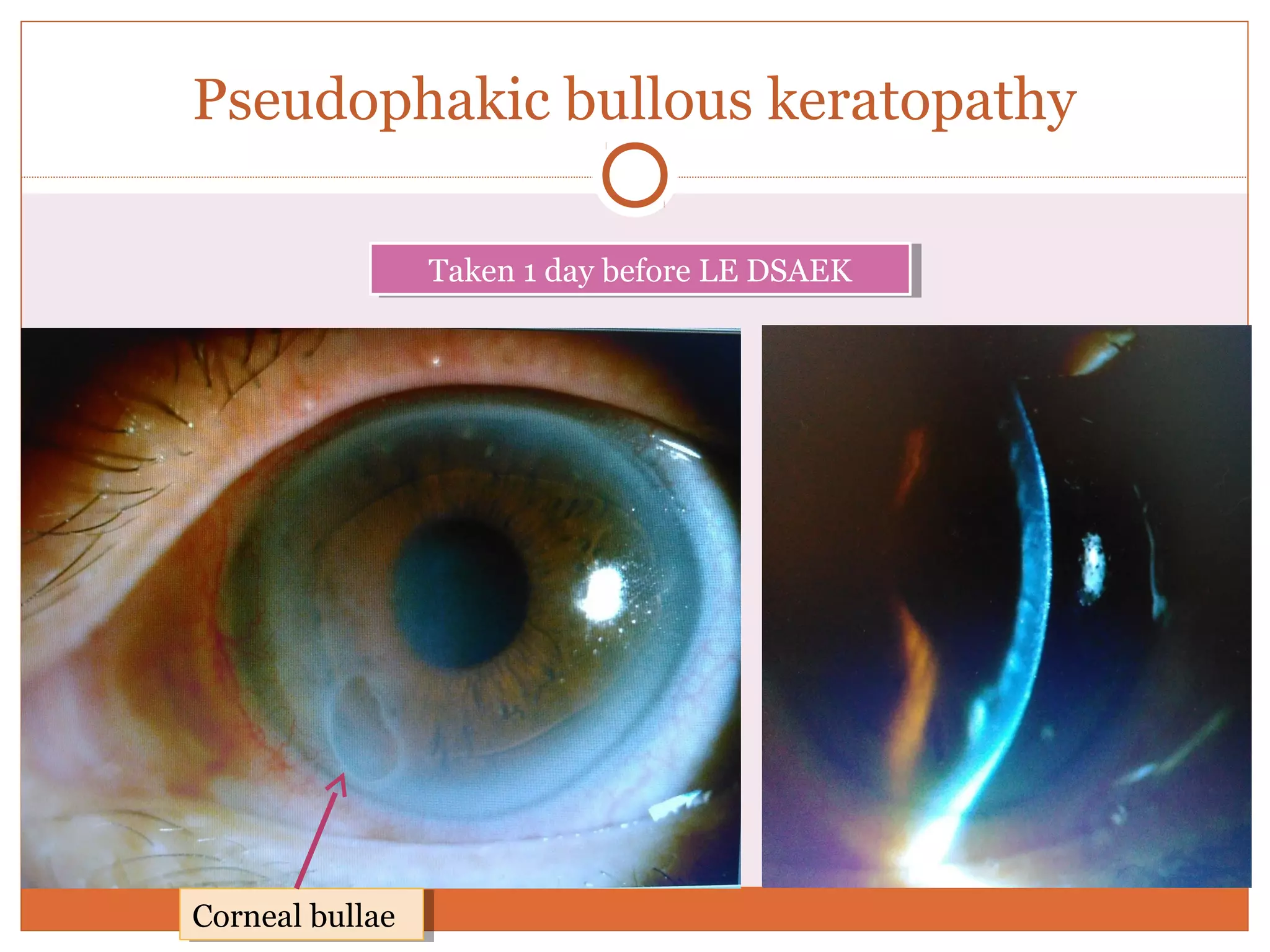 Pseudophakic Bullous Keratopathy case | PPT | Eye and Vision Conditions ...