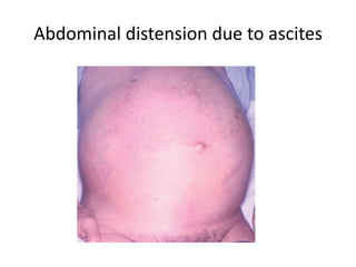 galactosemia | PPTX