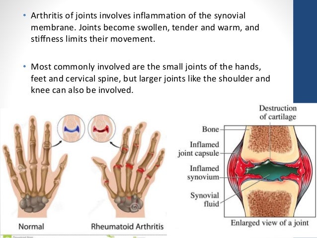 rheumatoid arthritis