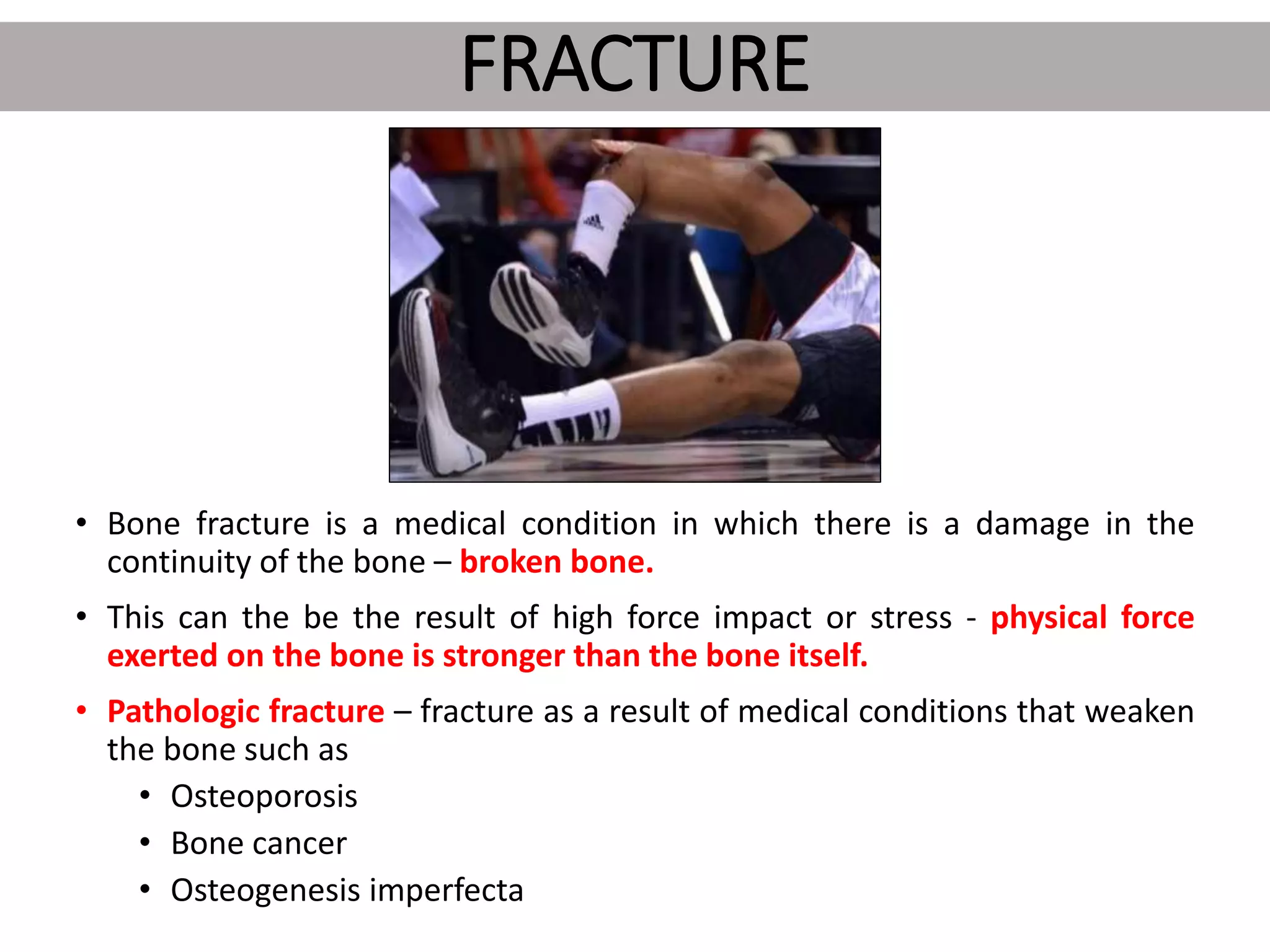 Types of Fractures | PPTX
