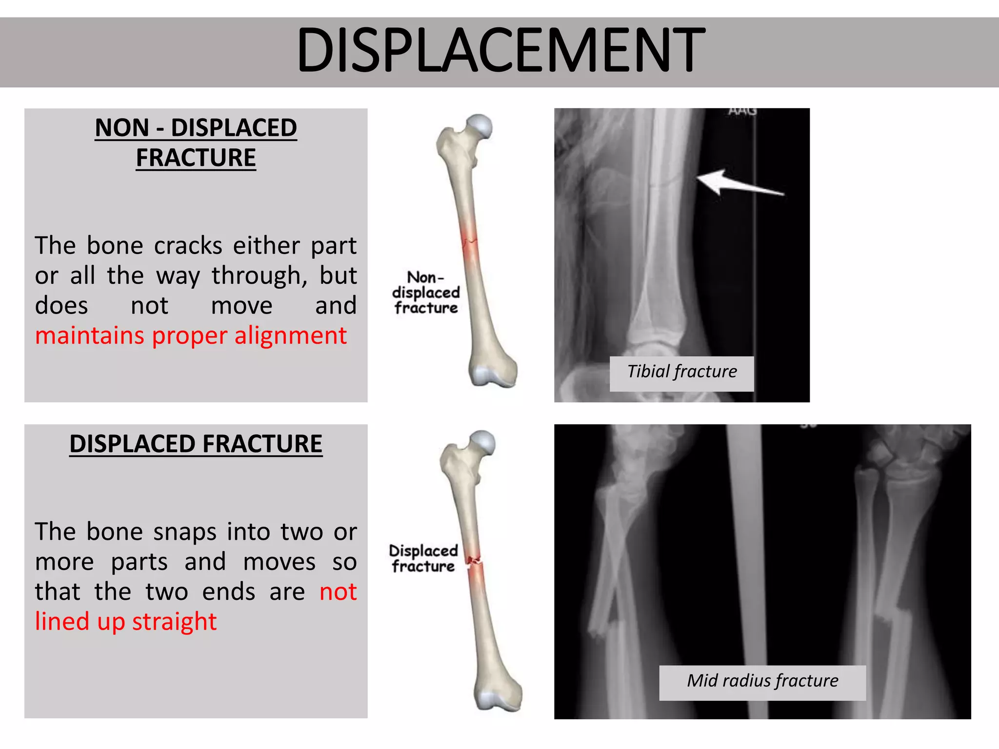 Types of Fractures | PPTX