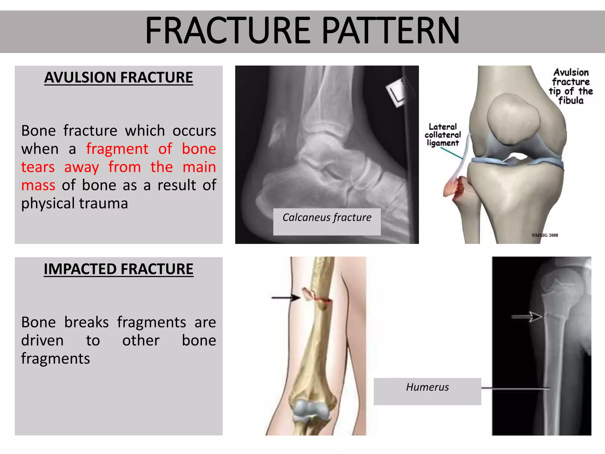Types of Fractures | PPTX