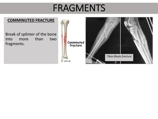 Types of Fractures | PPTX