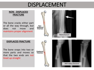 Types of Fractures | PPTX