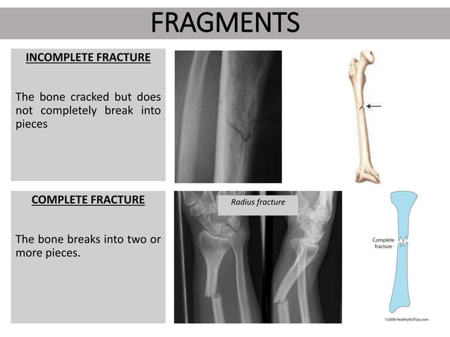 Types of Fractures | PPTX