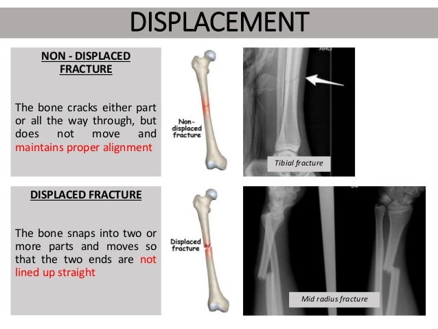 Types of Fractures