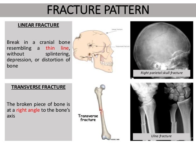 Types of Fractures