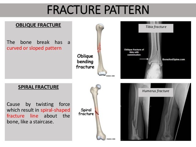 Types of Fractures