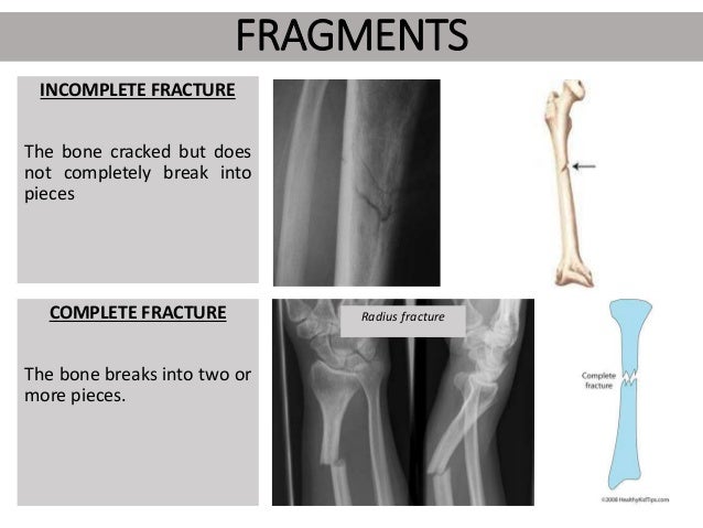 Types of Fractures