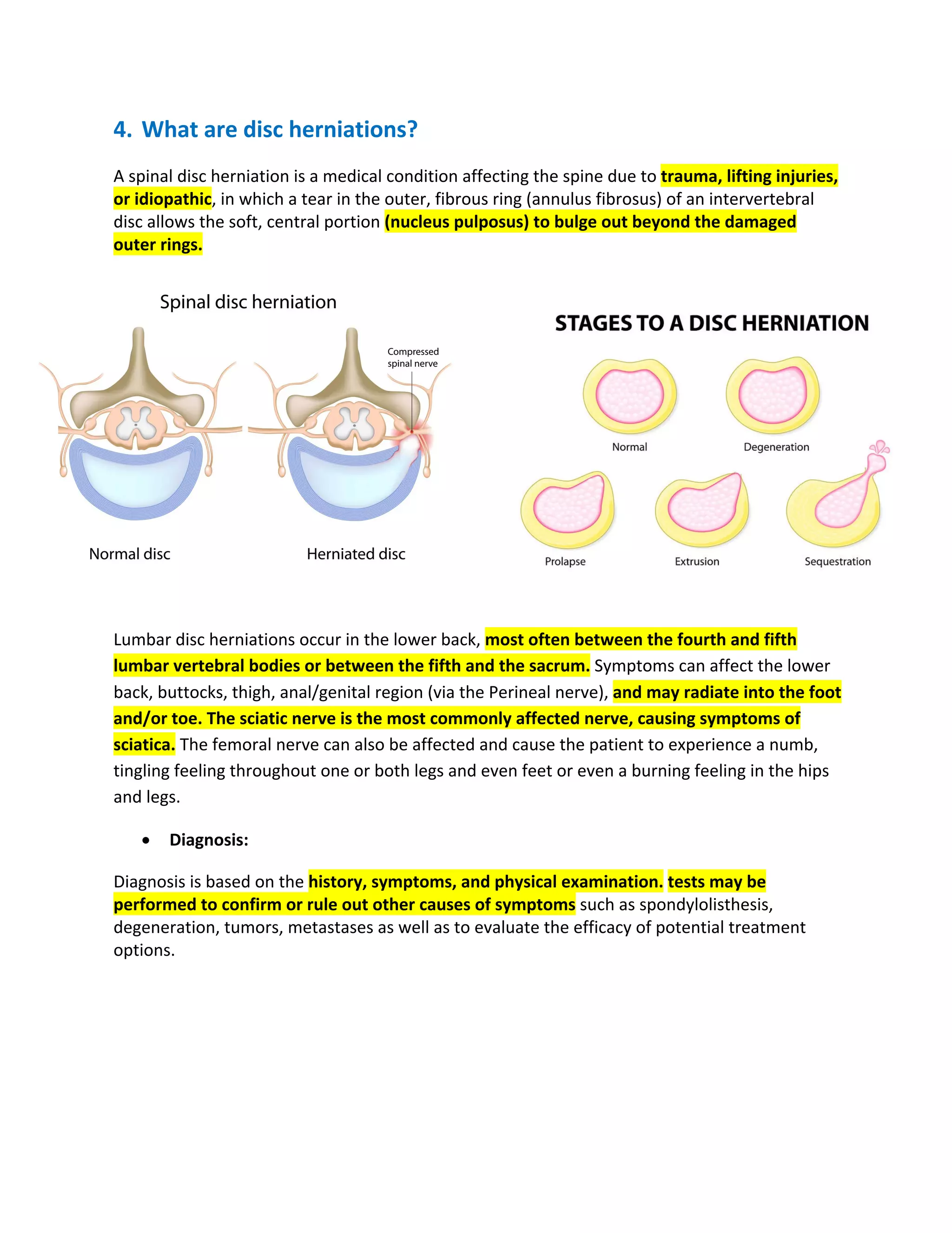 Disc Herniation | PDF