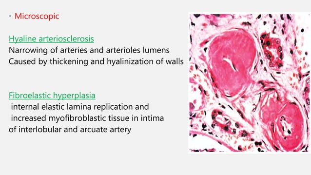kidney on hypertension | PPT