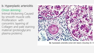 kidney on hypertension | PPTX