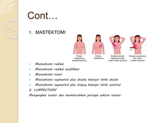 Pbl ca mammae | PPTX