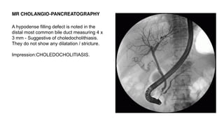 PBL cholelithiasis with choledocholithiasis.pptx