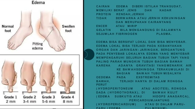 PROBLEM BASED LEARNING tentang "EDEMA" .pptx