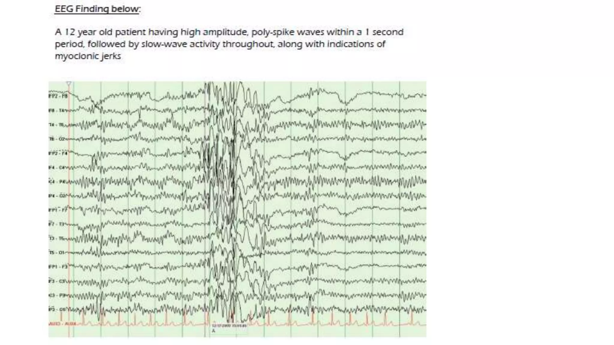 EEG Epilepsy | PPTX