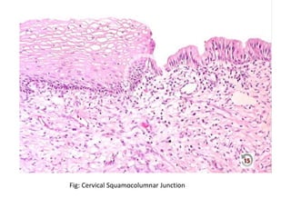 Cervical Carcinoma | PPT