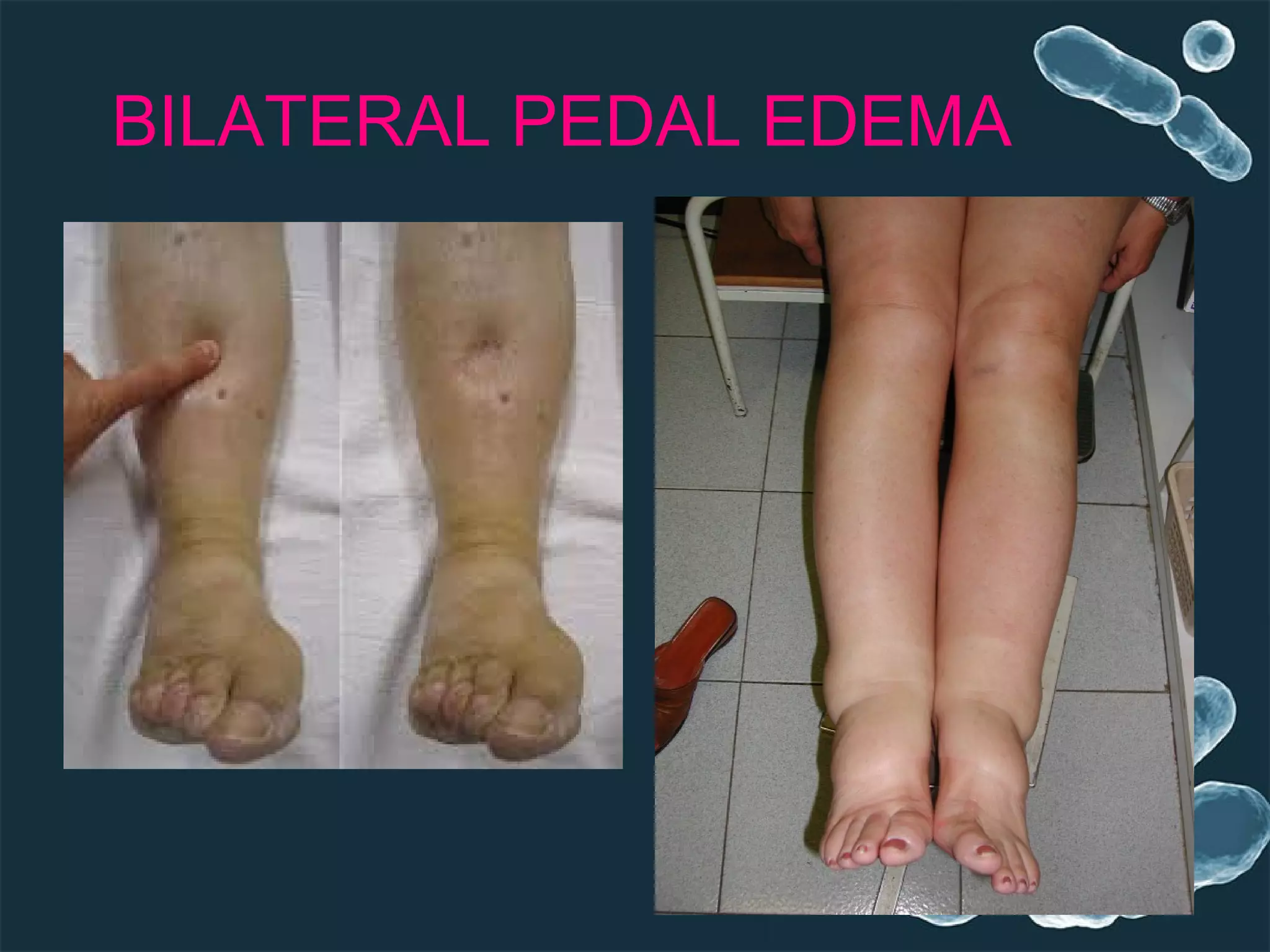 Pathophysiology of edema | PPT