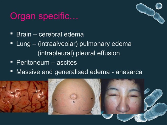 Pathophysiology of edema | PPT | Blood Disorders | Diseases and Conditions
