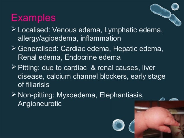 Pathophysiology of edema