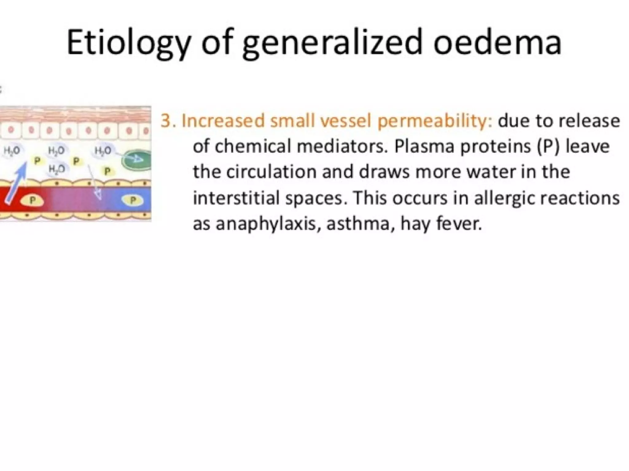 Pathophysiology of generalised edema | PPT
