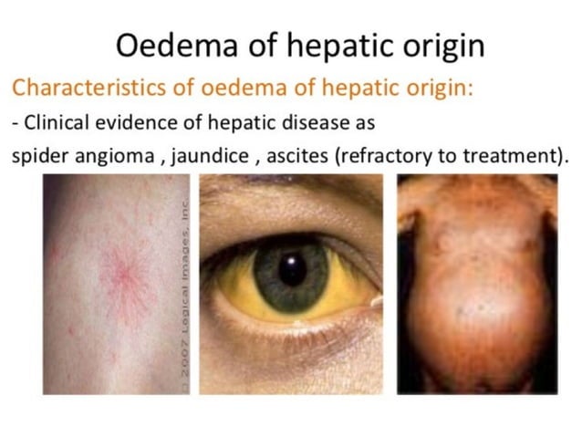 Pathophysiology of generalised edema | PPT