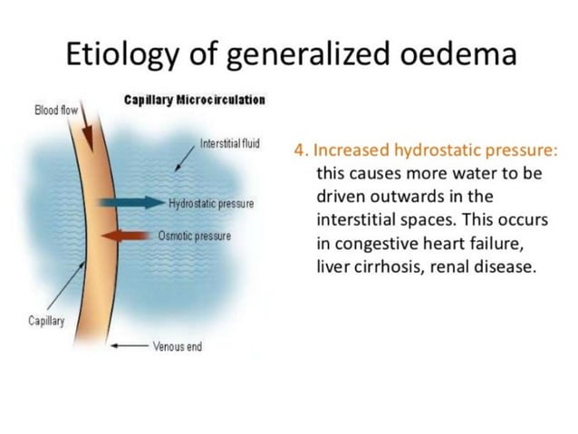 Pathophysiology of generalised edema | PPT