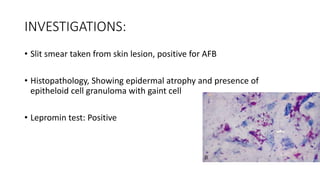 case study leprosy | PPTX