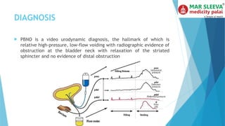 PRIMARY BLADDER NECK OBSTRUCTION MANAGEMENT | PPT