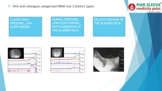 PRIMARY BLADDER NECK OBSTRUCTION MANAGEMENT | PPT