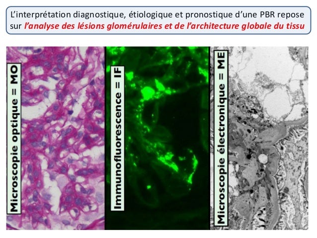 La Ponction biopsie rénale