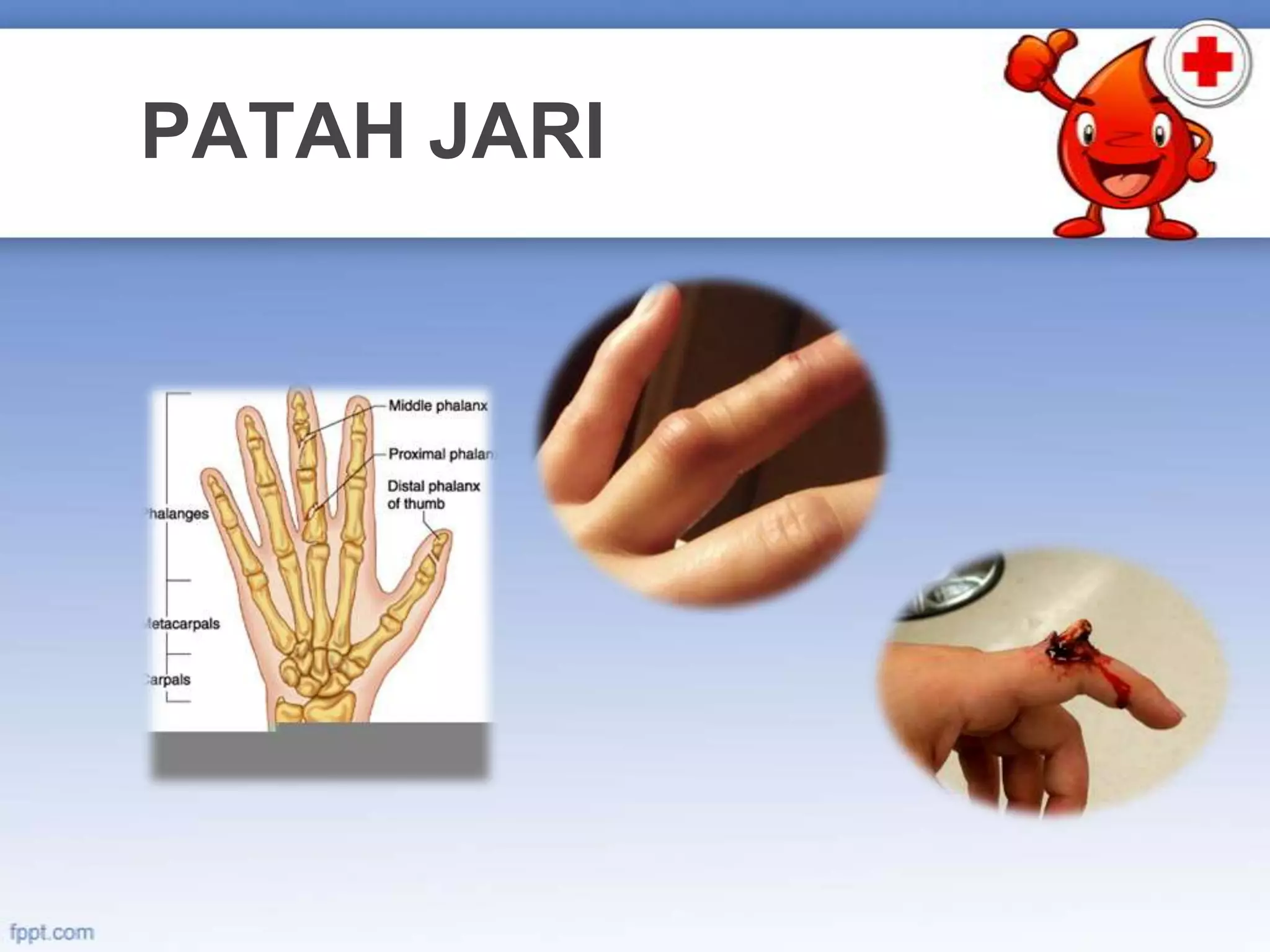 PBSM 2012 patah dan terseliuh | PPTX