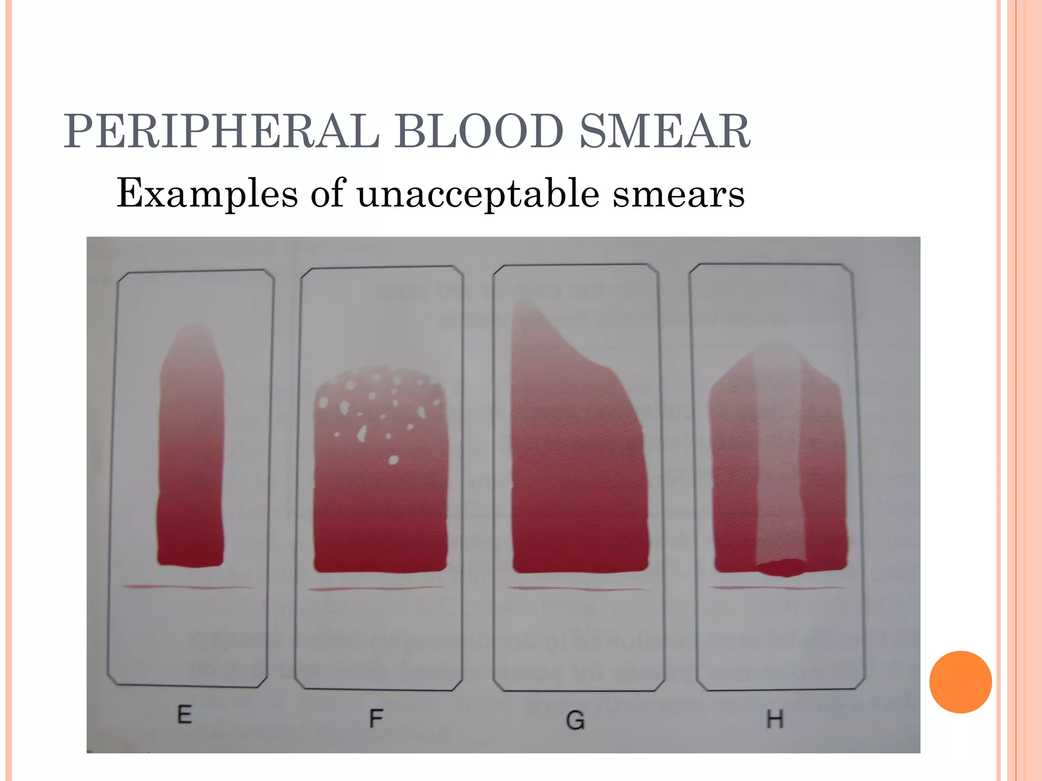 Peripheral blood Smear Preparation | PPT Peripheral blood Smear Preparation | PPT