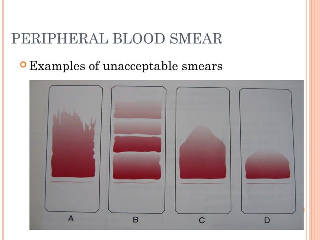 Peripheral blood Smear Preparation | PPT | Blood Disorders | Diseases ...