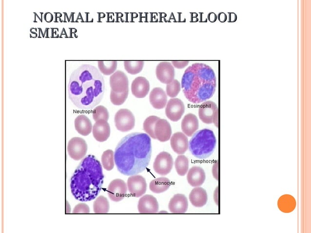 Peripheral blood Smear Preparation | PPT | Blood Disorders | Diseases ...