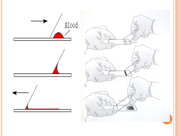Peripheral blood Smear Preparation | PPT | Blood Disorders | Diseases ...