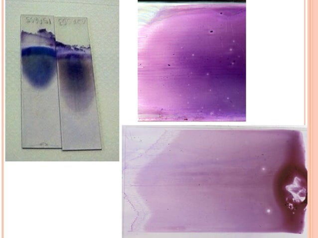 Peripheral blood Smear Preparation | PPT | Blood Disorders | Diseases ...