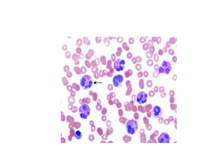 Peipheral blood smeasr and staining done | PPT