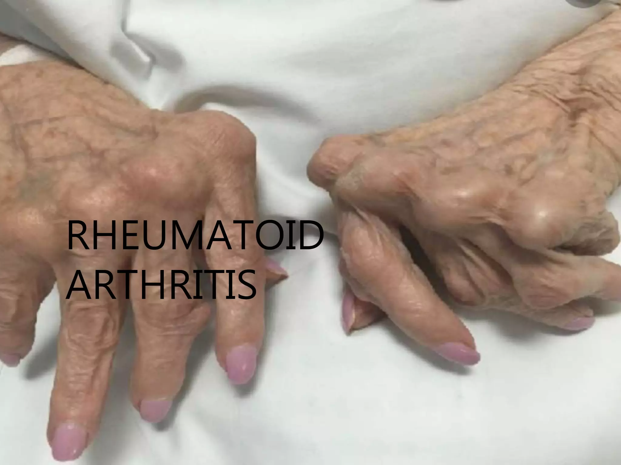 PATHO-PHYSIOLOGY OF RHEUMATOID ARTHRITIS, GOUT & ANEMIA | PPTX