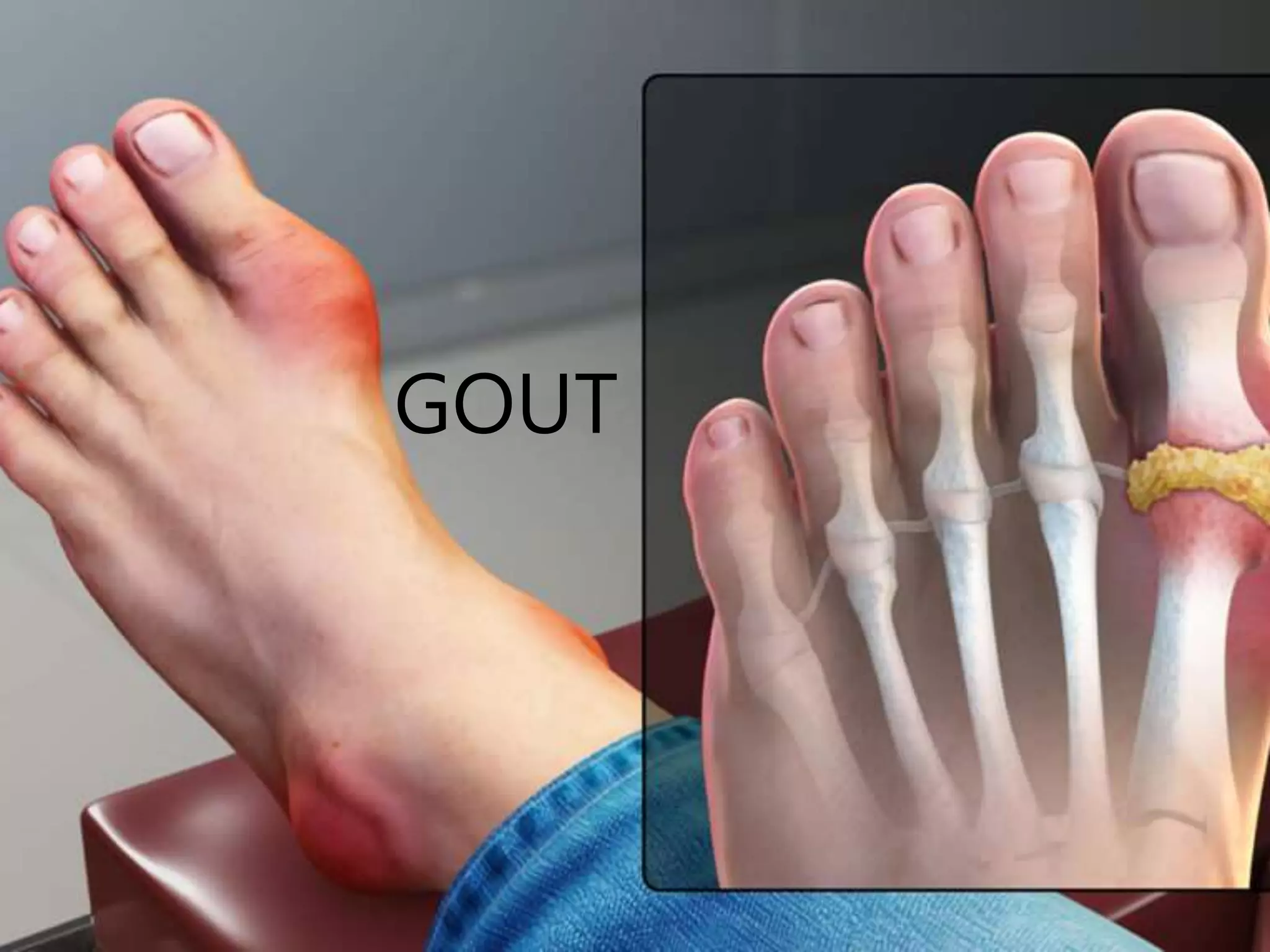 PATHO-PHYSIOLOGY OF RHEUMATOID ARTHRITIS, GOUT & ANEMIA | PPTX