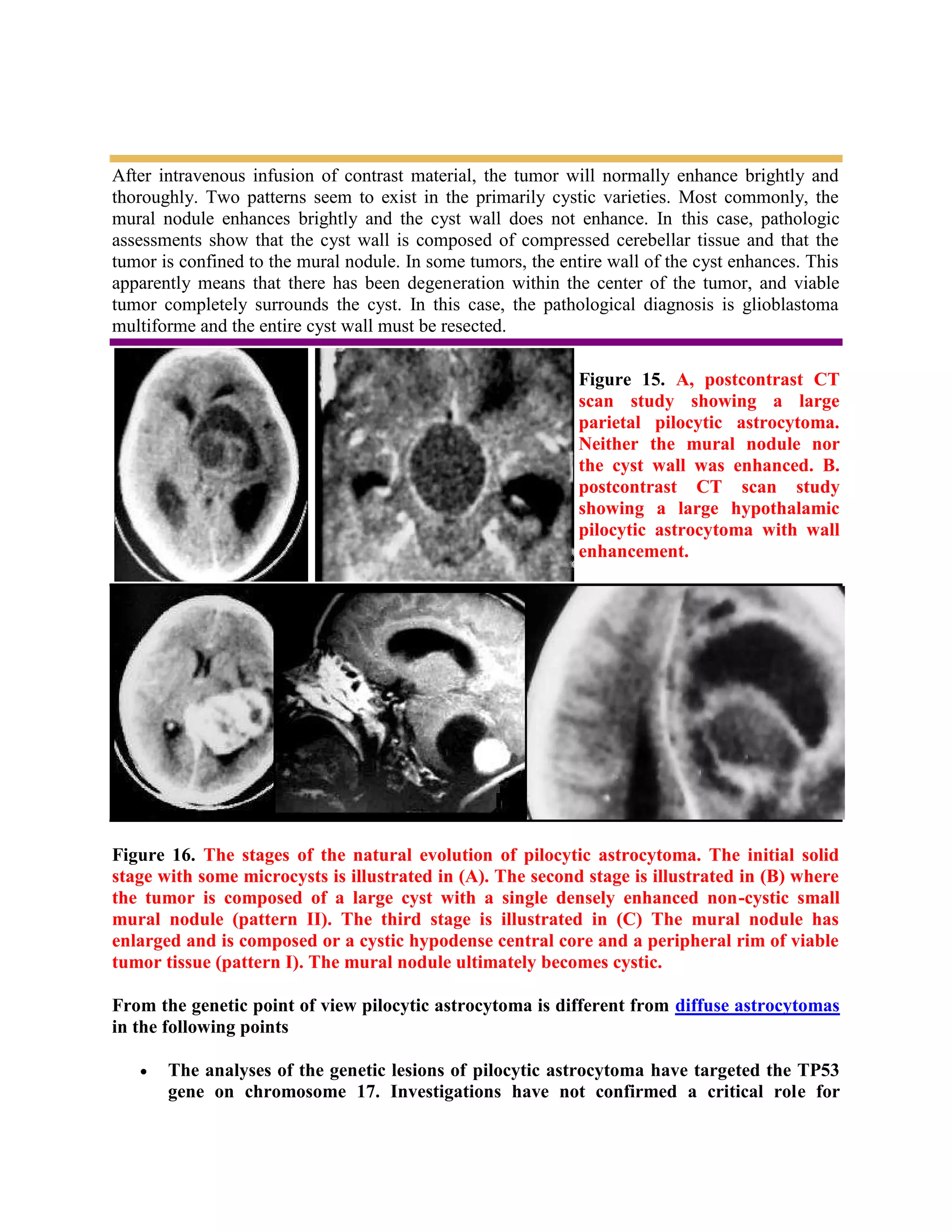 Topic of the month: Radiological pathology of pilocytic astrocytoma | PDF