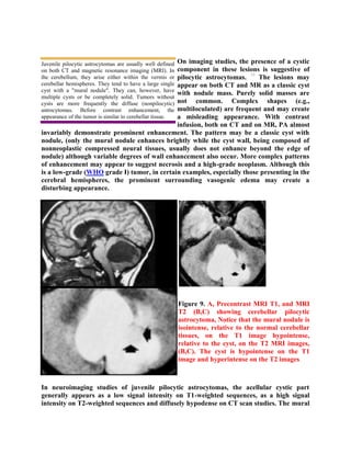 Topic of the month: Radiological pathology of pilocytic astrocytoma | PDF