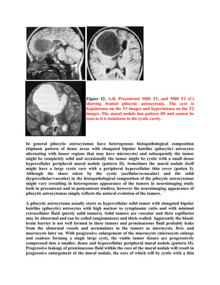 Topic of the month: Radiological pathology of pilocytic astrocytoma | PDF